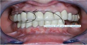 Tooth Decay Under Bridge- Causes and Symptoms – Anaya Dental