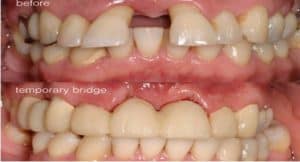 Temporary Dental Bridge- Why, Benefits, Pictures & Material