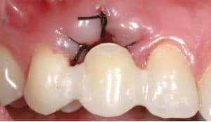 Temporary Dental Bridge- Why, Benefits, Pictures & Material