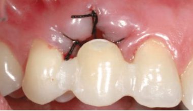 Temporary Dental Bridge- Why, Benefits, Pictures & Material