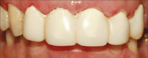 Temporary Dental Bridge- Why, Benefits, Pictures & Material