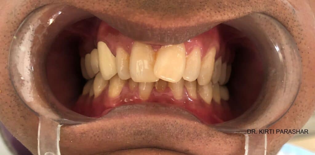 Before and After: Temporary Dental Crown & Bridge Pictures - Anaya Dental