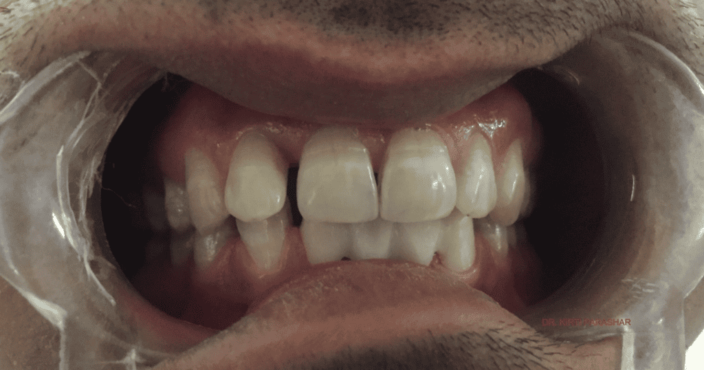 Before and After: Temporary Dental Crown & Bridge Pictures - Anaya Dental