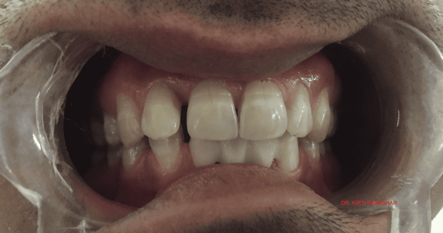 Before and After: Temporary Dental Crown & Bridge Pictures - Anaya Dental