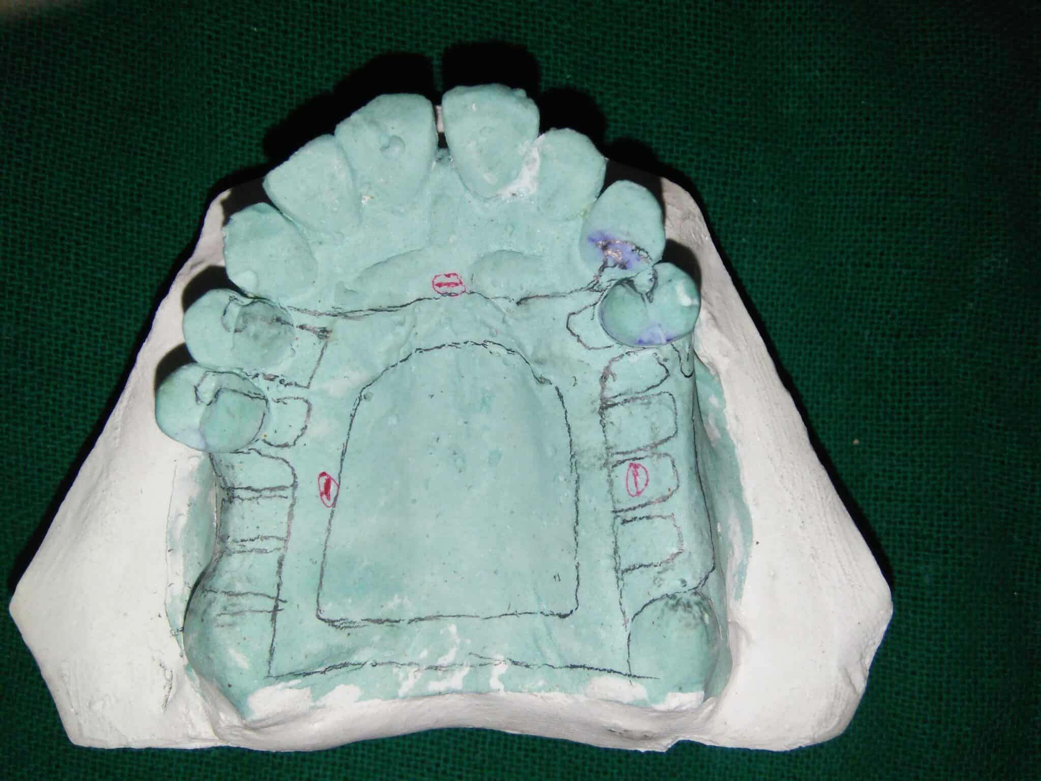 All you need to know about cast partial denture - Anaya Dental