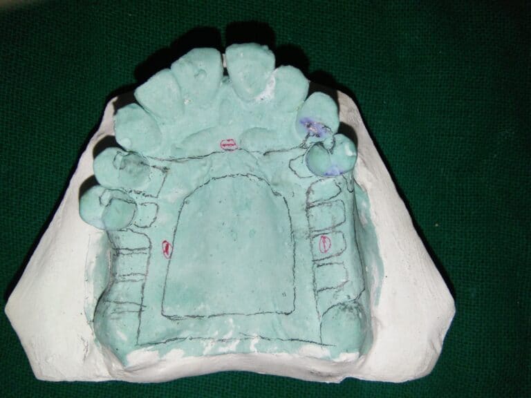 All you need to know about cast partial denture - Anaya Dental