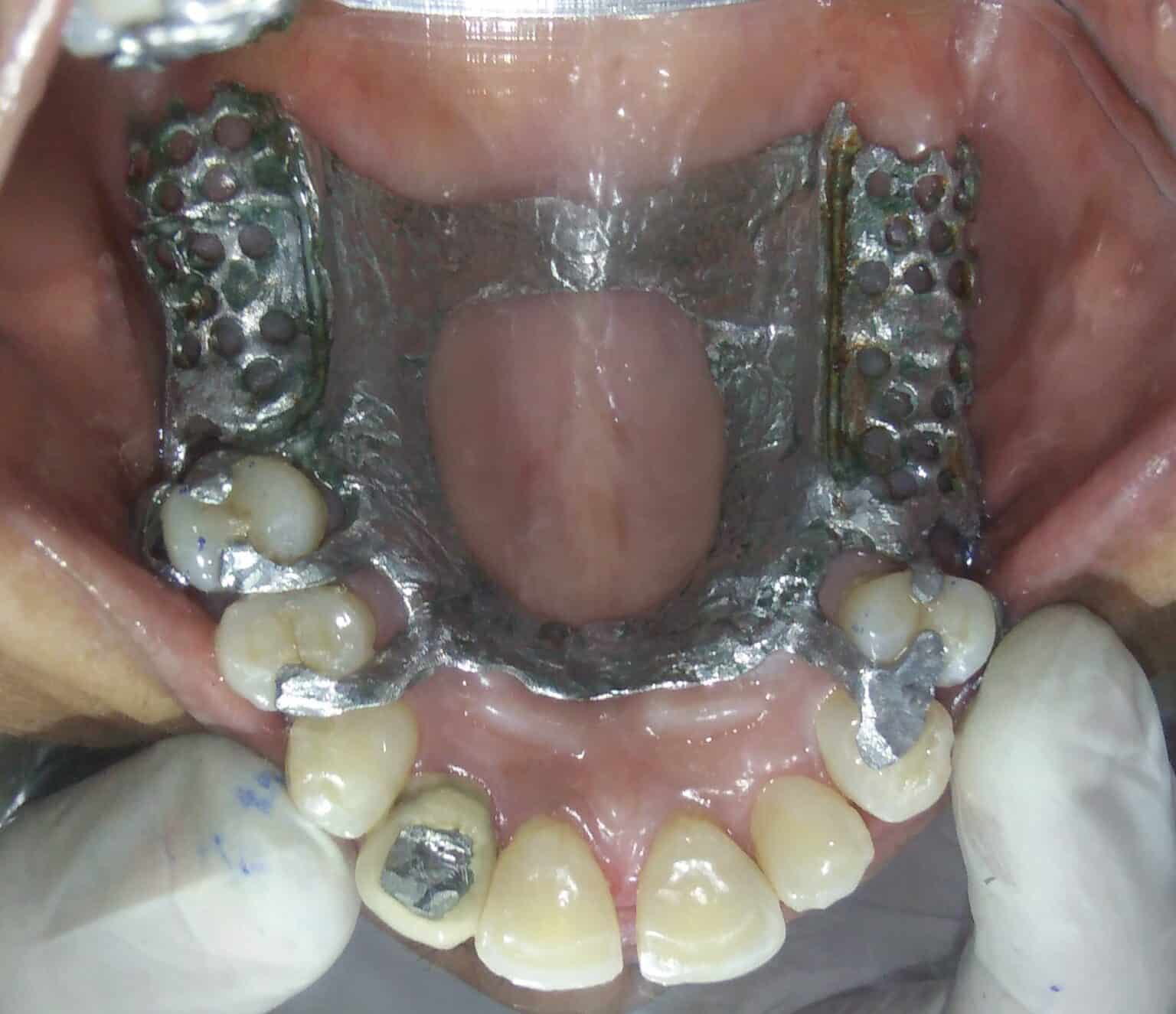 All you need to know about cast partial denture - Anaya Dental