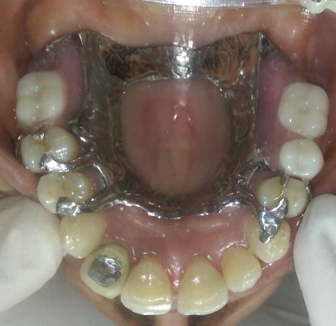 All you need to know about cast partial denture - Anaya Dental