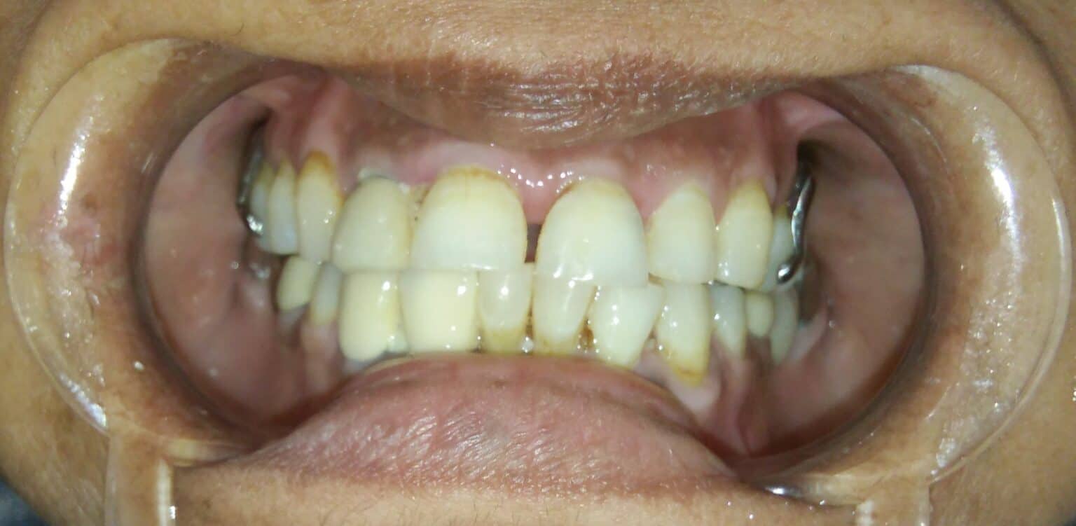 All you need to know about cast partial denture - Anaya Dental
