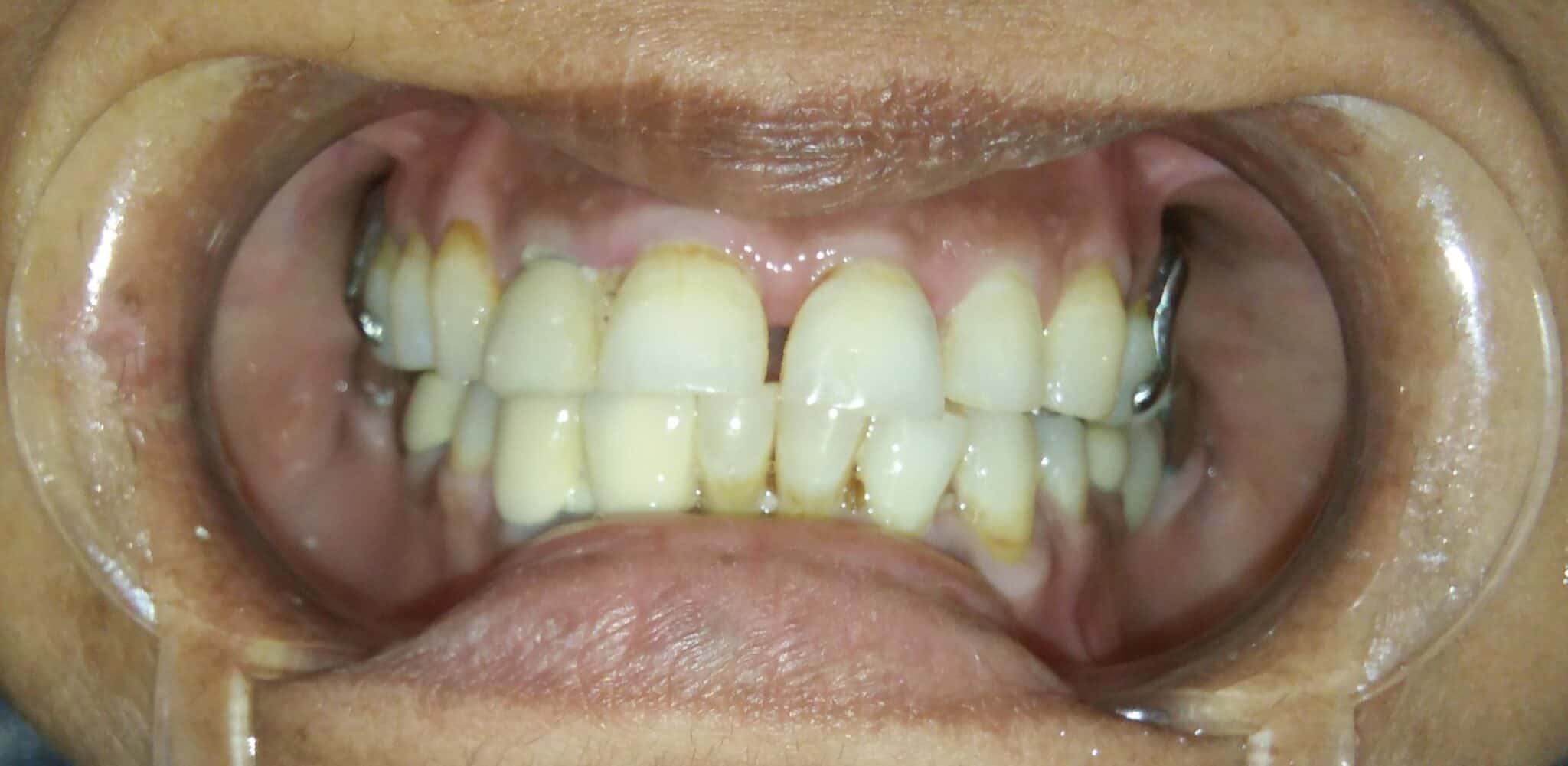 All you need to know about cast partial denture - Anaya Dental
