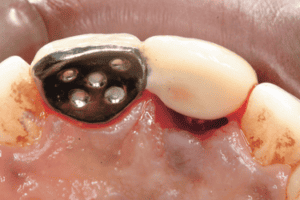 Resin Bonded Bridges- Virginia Bridges And Maryland Bridges - Anaya Dental