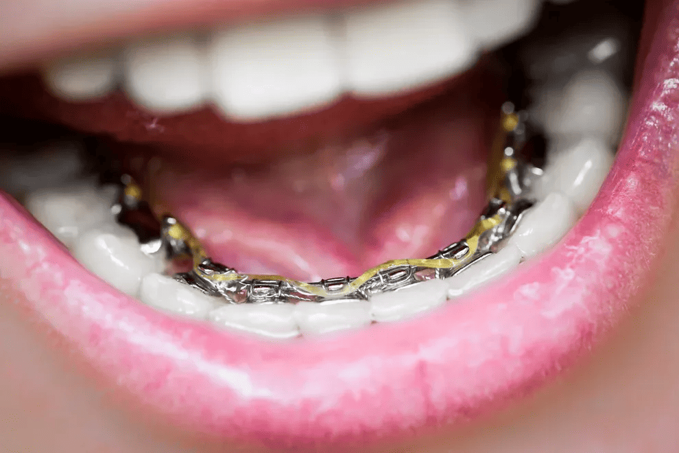 all you need to know about crooked teeth - Anaya Dental