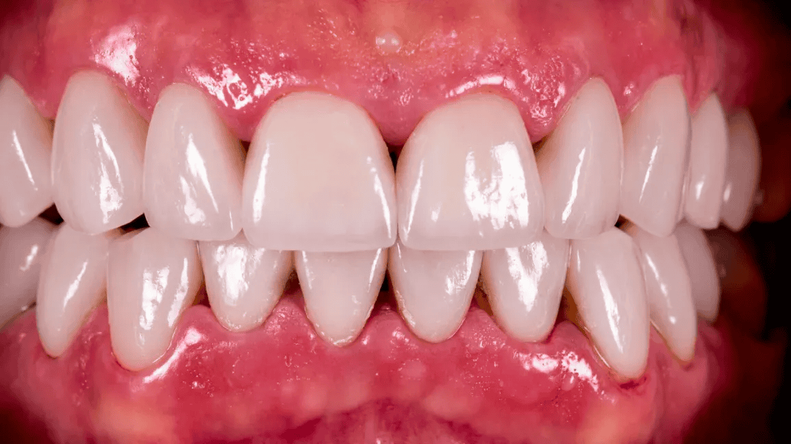 Gaps after braces: Why and What to do? - Anaya Dental