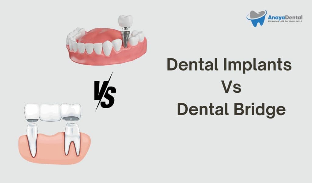 Dental Implants vs Dental Bridges: Key Differences & Best Choice - Anaya Dental