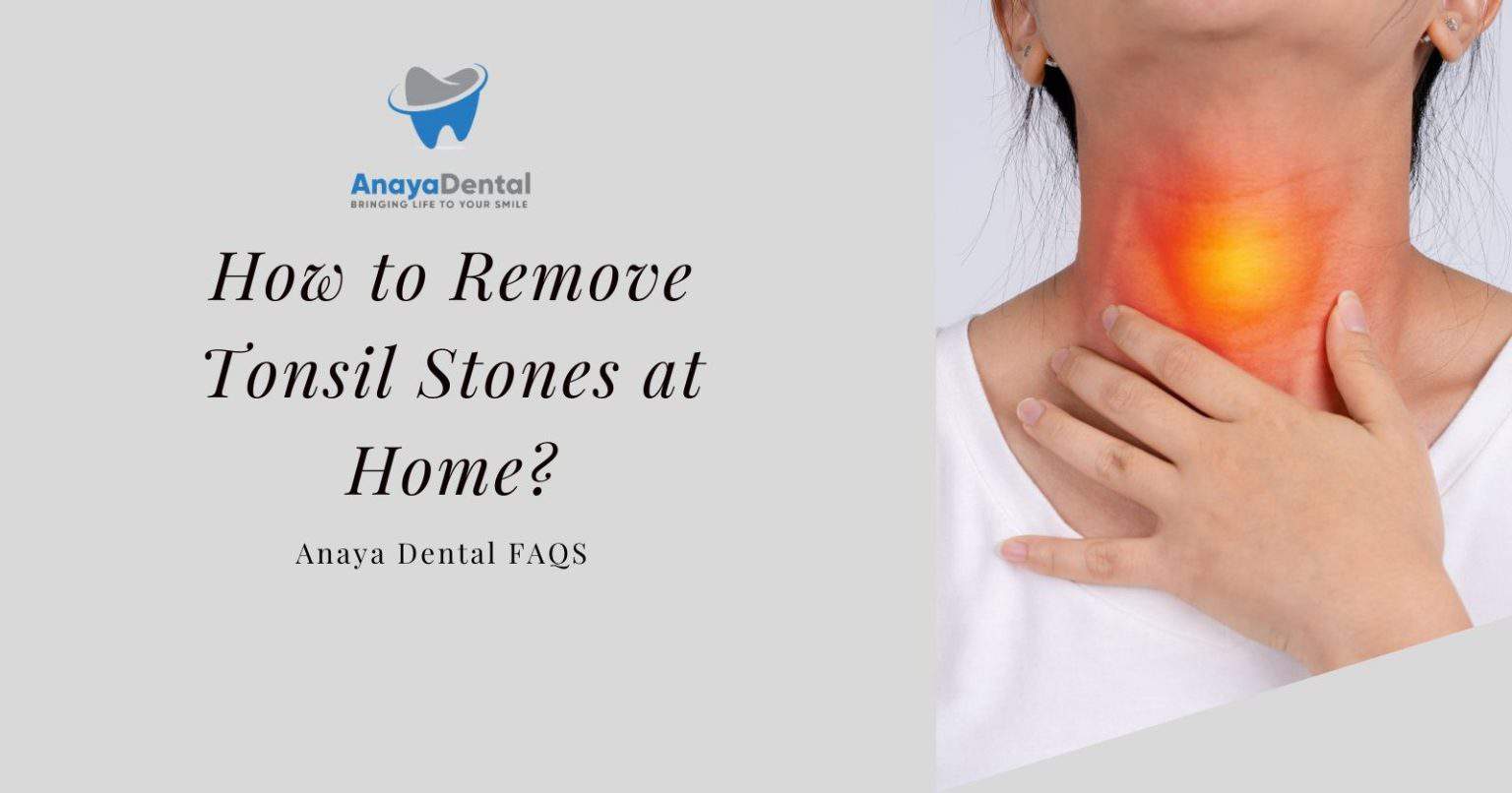 15 Easy Ways To Remove Tonsil Stones at Home - Anaya Dental