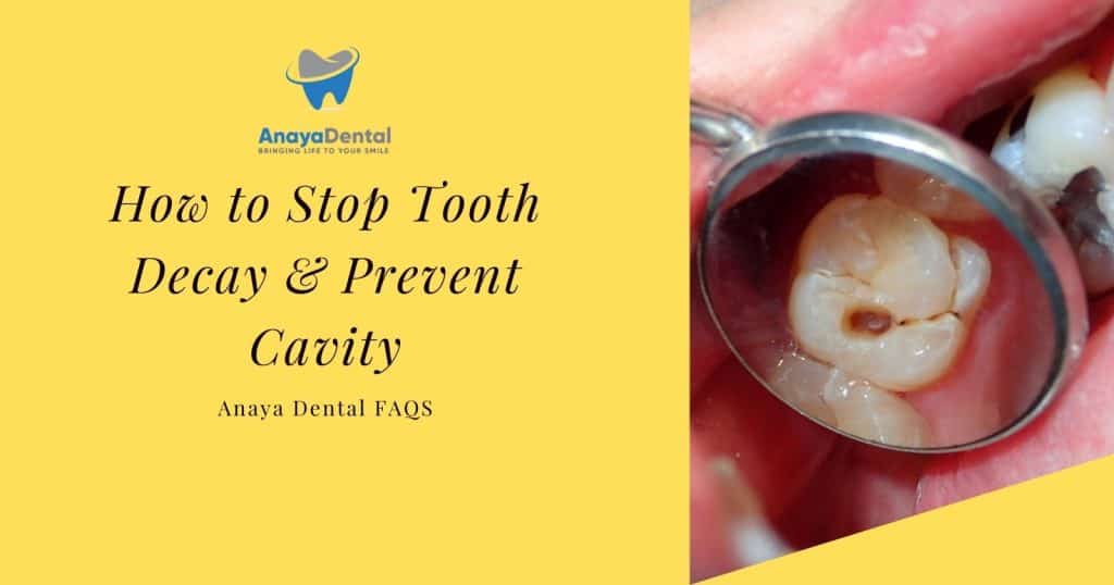 How to Stop Tooth Decay and Prevent Cavities: Essential Tips for Dental ...