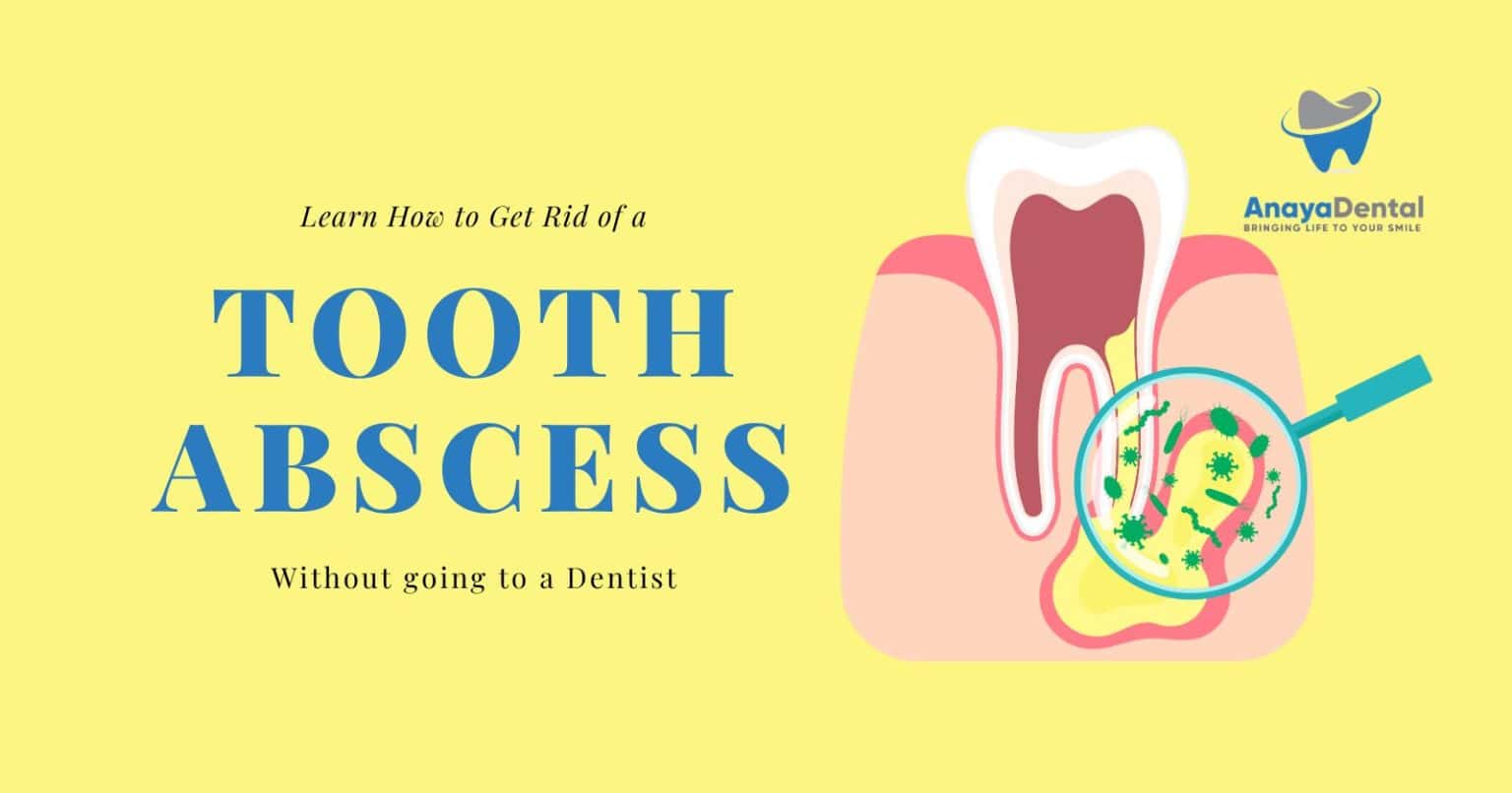 How To Get Rid Of A Tooth Abscess At Home Without Visiting The Dentist Anaya Dental