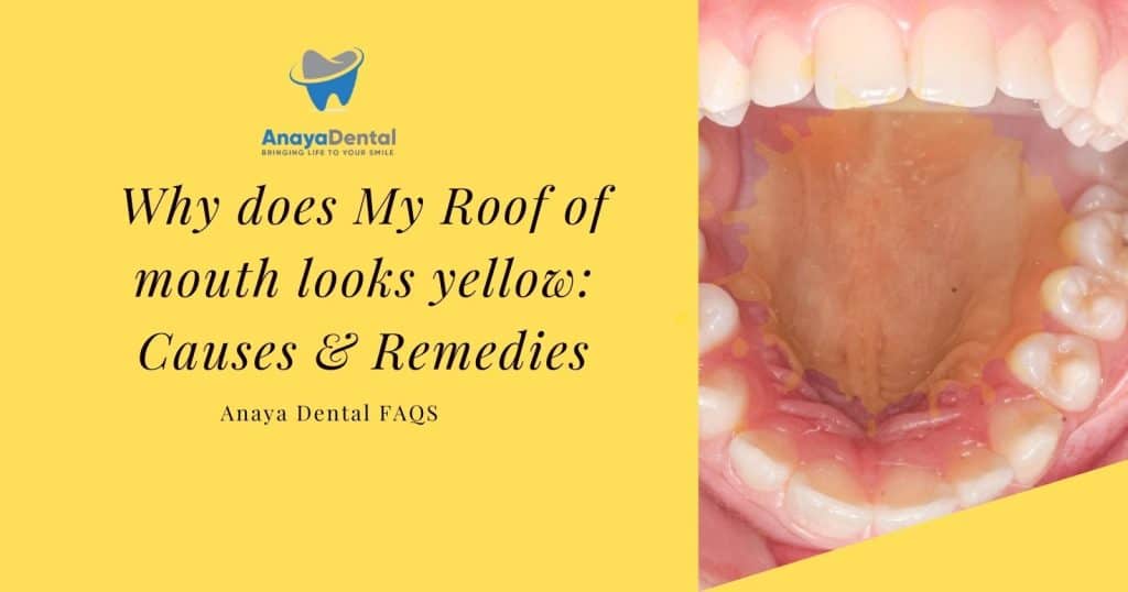 Is Your Roof of Mouth Yellow? Causes, Symptoms, and Treatments Explained