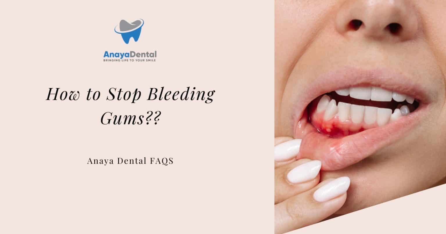 How to Stop bleeding gums - Anaya Dental