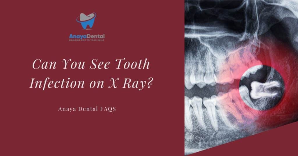 Can You See Tooth Infection on X Ray? - Anaya Dental