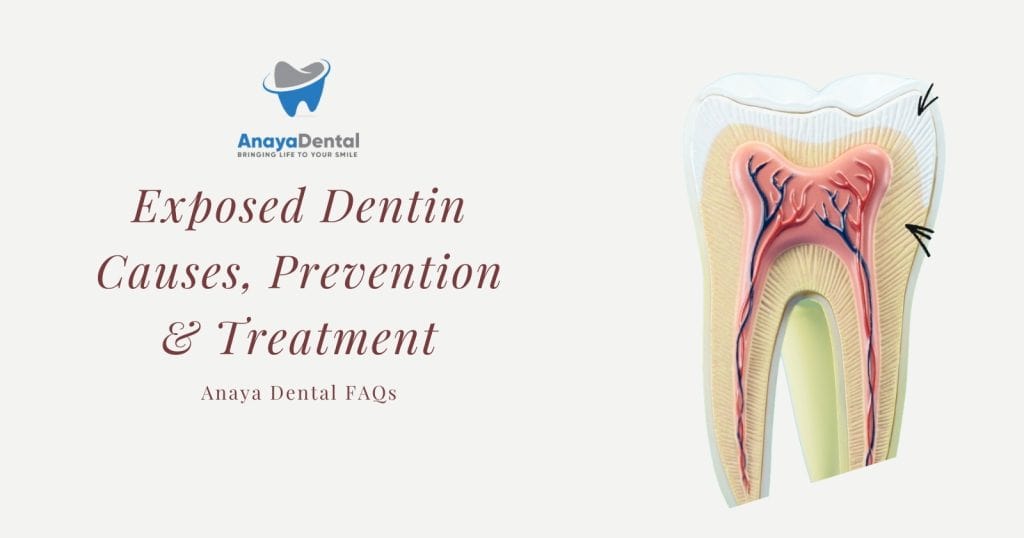 Exposed Dentin – Causes, Prevention & Treatment - Anaya Dental