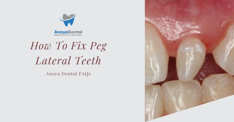 How To Fix Peg Lateral Teeth? - Anaya Dental