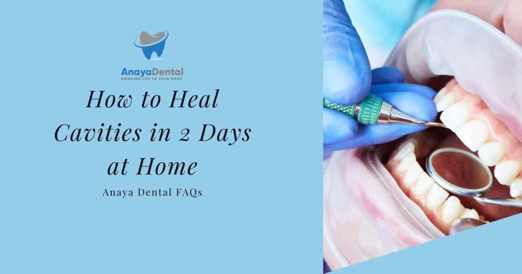How to Heal Cavities in 2 Days at Home - Anaya Dental