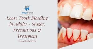 Loose Tooth Bleeding in Adults – Stages, Precautions & Treatment ...