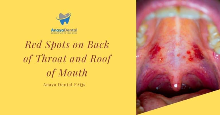Red Spots on the Roof of Mouth: Causes & Treatment - Anaya Dental