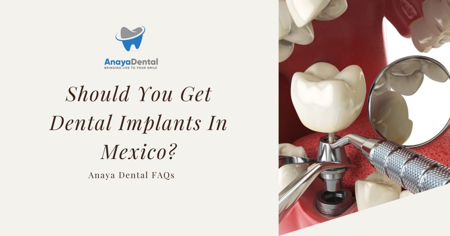 Should You Get Dental Implants In Mexico? - Anaya Dental
