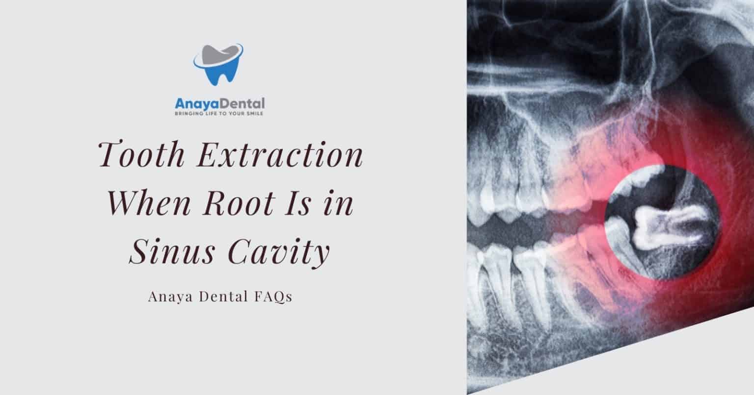 Tooth Extraction When Root Is in Sinus Cavity - Anaya Dental