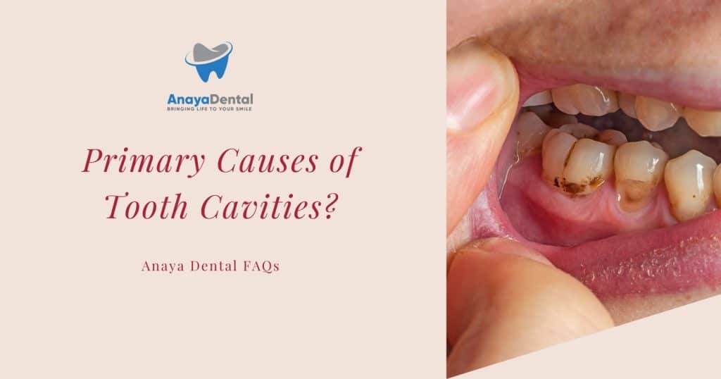What Causes Tooth Cavities? - Anaya Dental