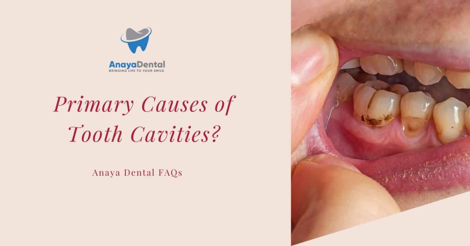 What Causes Tooth Cavities? - Anaya Dental