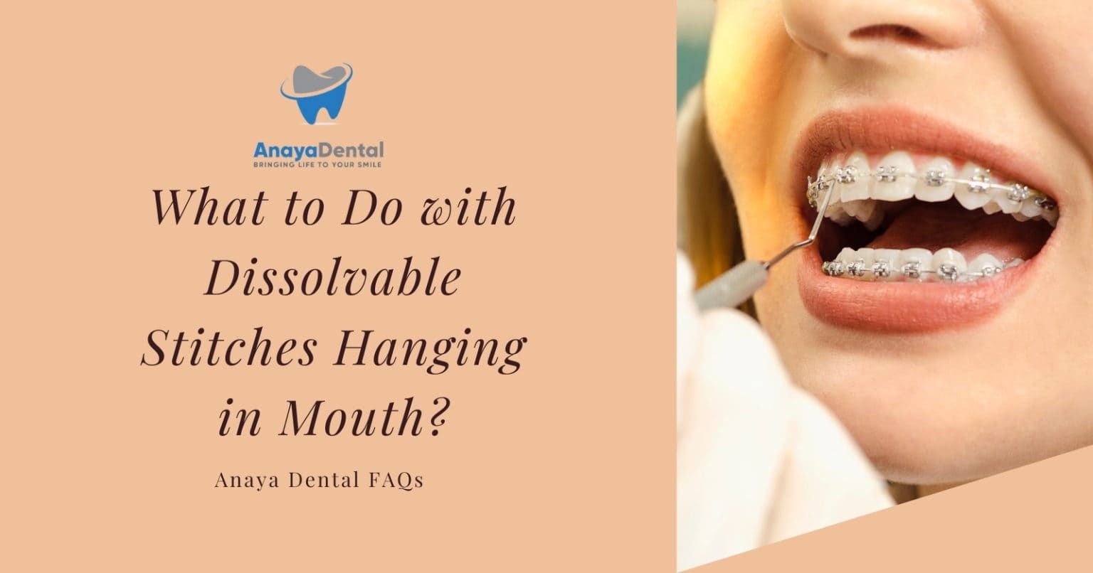 What to Do with Dissolvable Stitches Hanging in Mouth? - Anaya Dental