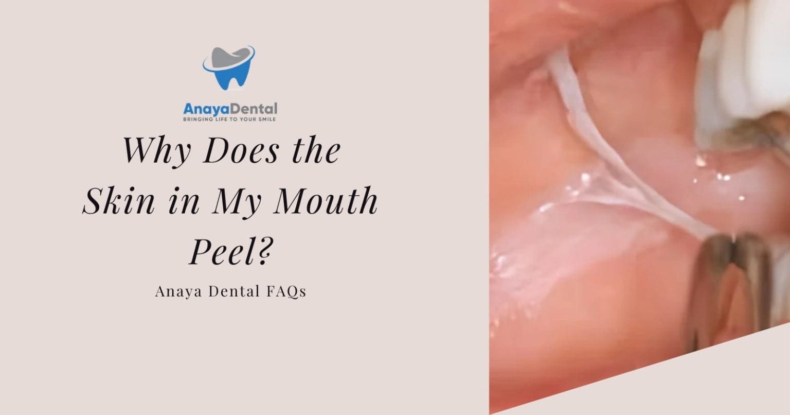 Why Does the Skin in My Mouth Peel? - Anaya Dental