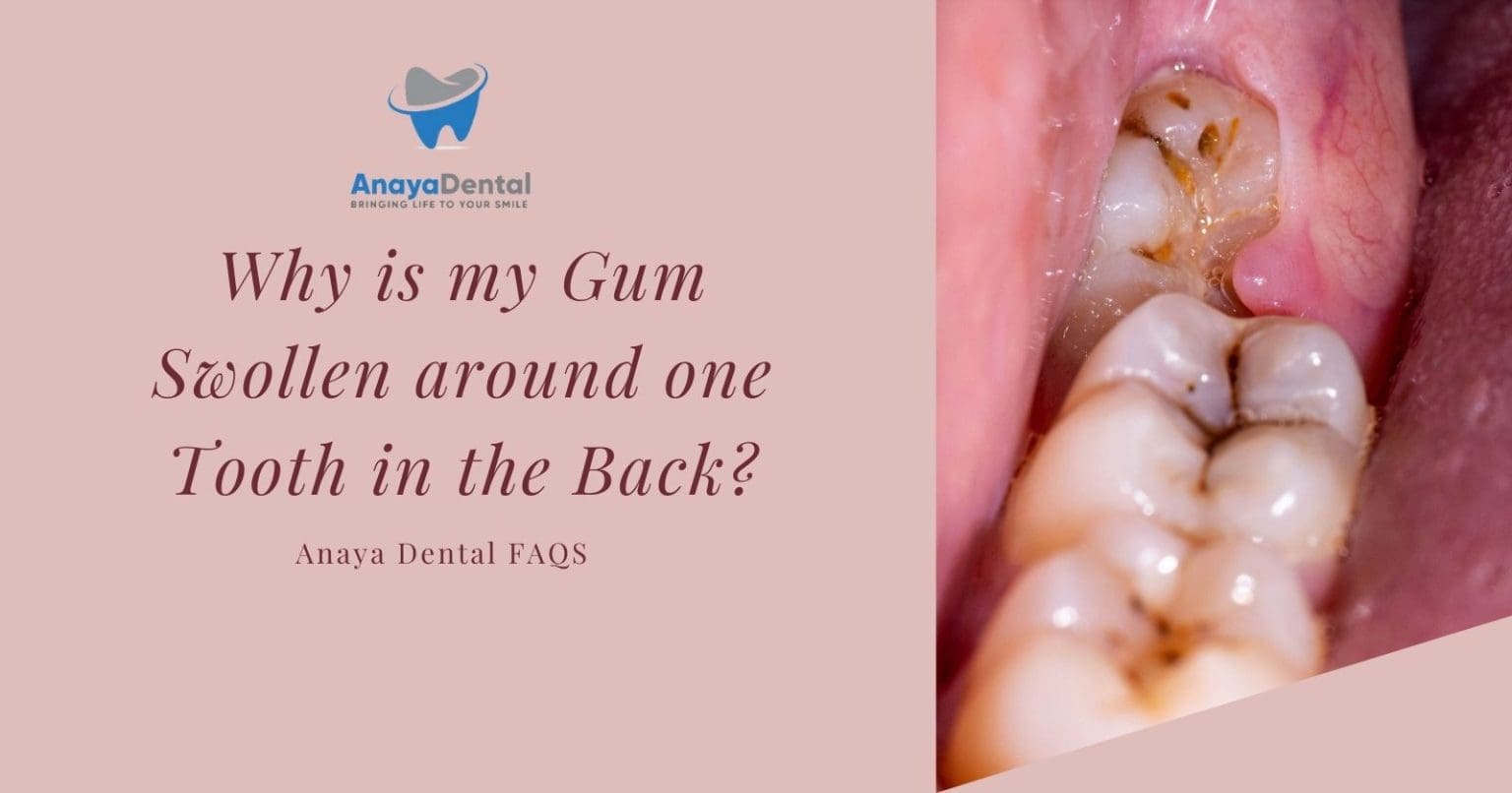 Why is my Gum Swollen around one Tooth in the Back? - Anaya Dental