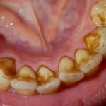 Why is Tartar Breaking Off Teeth? - Anaya Dental