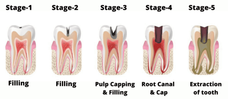 Loose Tooth Bleeding in Adults – Stages, Precautions & Treatment ...