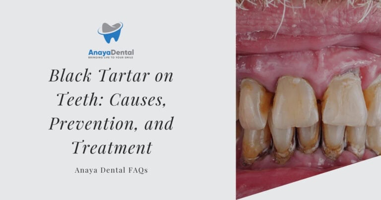 Black Tartar on Teeth: Causes, Prevention, and Treatment - Anaya Dental