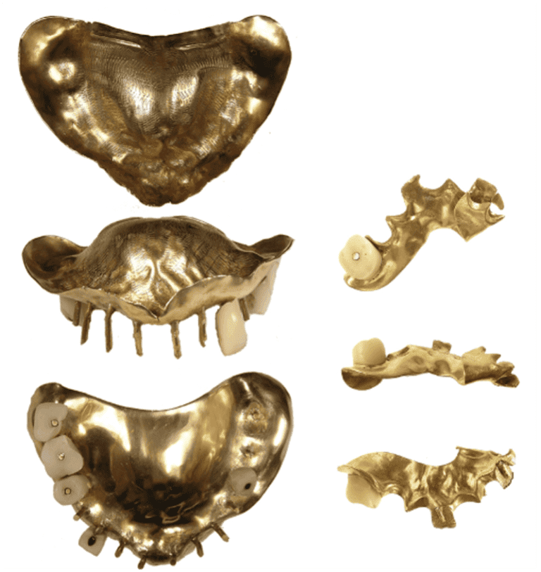 Dental Gold: Everything You Need to Know About the Golden Standard of ...