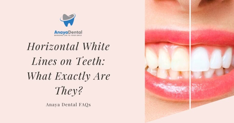 Horizontal White Lines on Teeth: What Exactly Are They? - Anaya Dental
