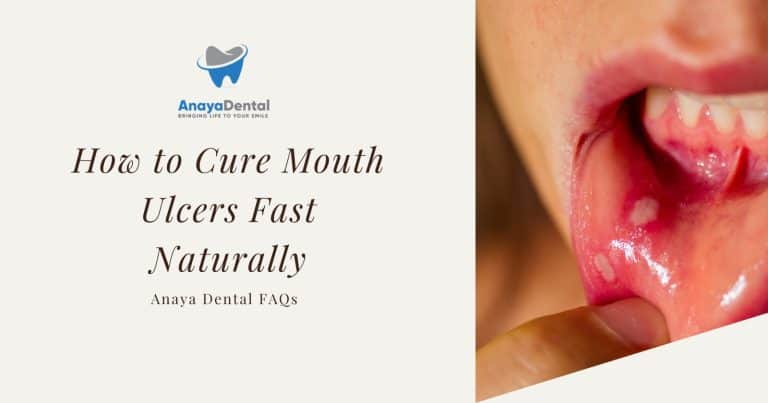 How to Cure Mouth Ulcers Fast Naturally? Best Ways Explained - Anaya Dental