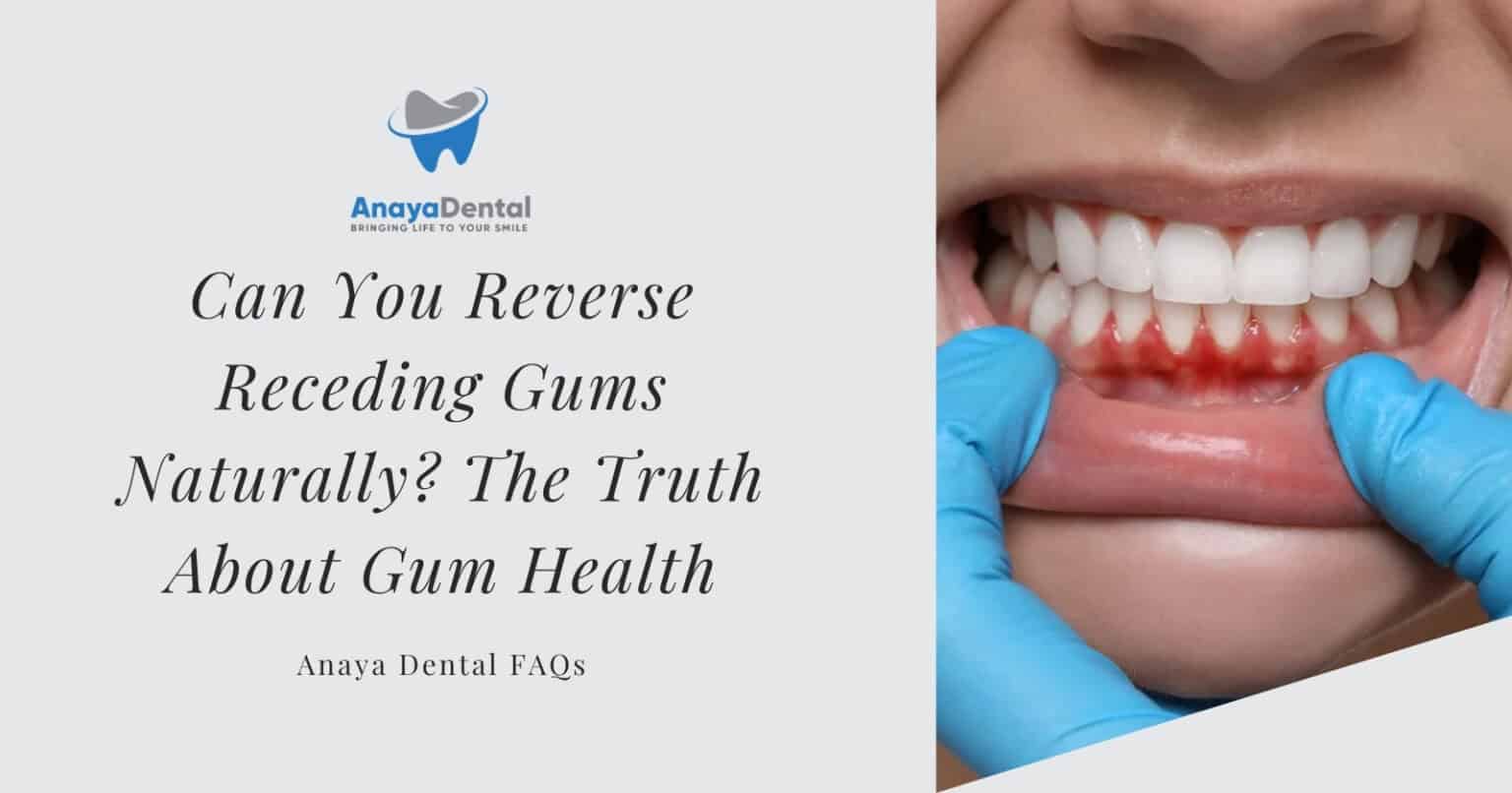 Can You Reverse Receding Gums Naturally? The Truth About Gum Health ...