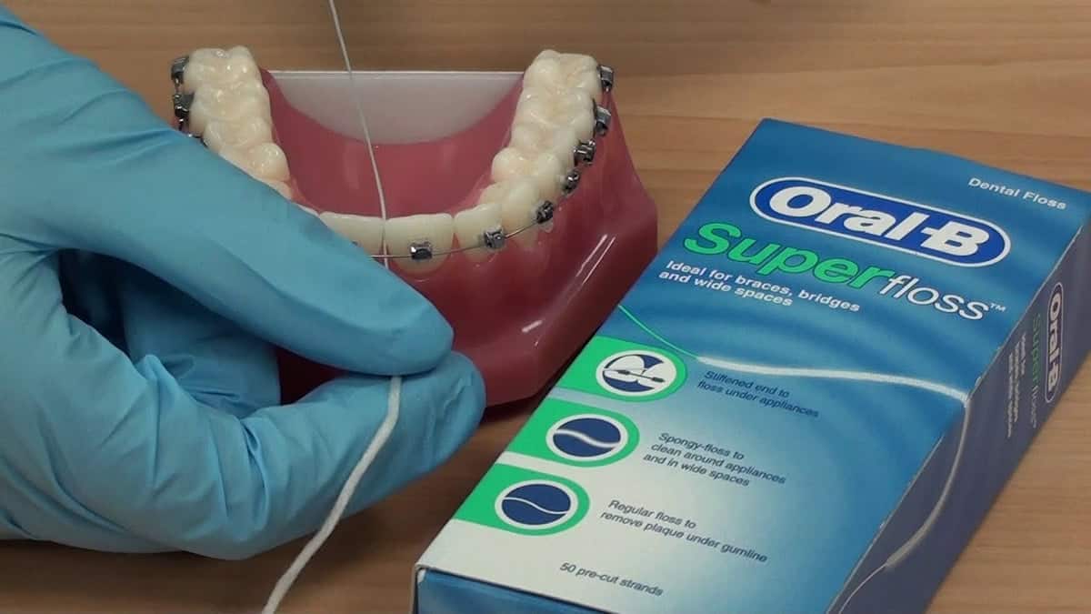 Best Floss for Permanent Retainer: Top 5 Options for Perfect Oral ...