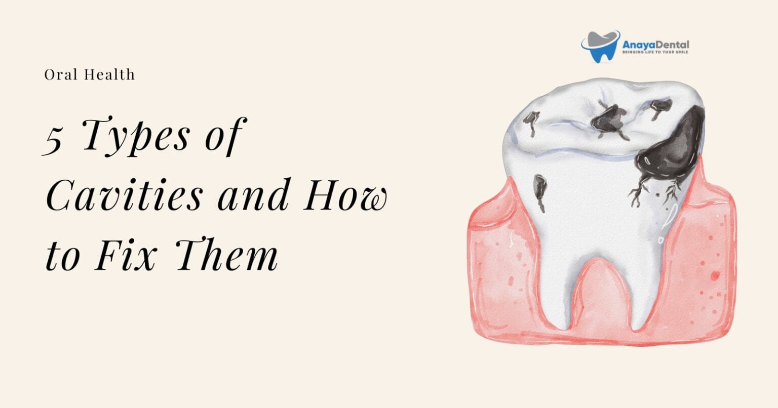 5 Types of Cavities and How to Fix Them - Anaya Dental