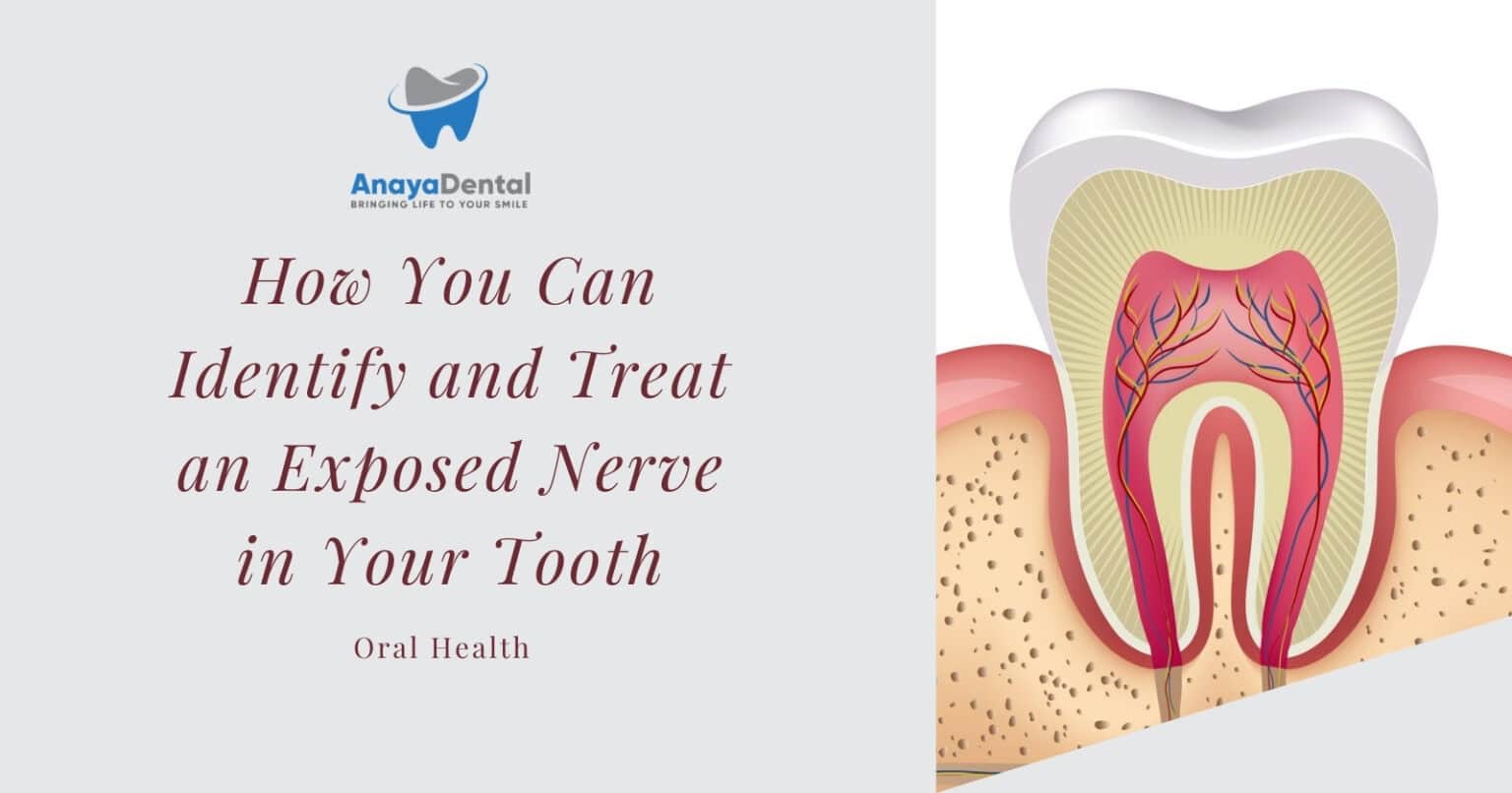 Exposed Nerve in Tooth: Symptoms & Treatments - Anaya Dental