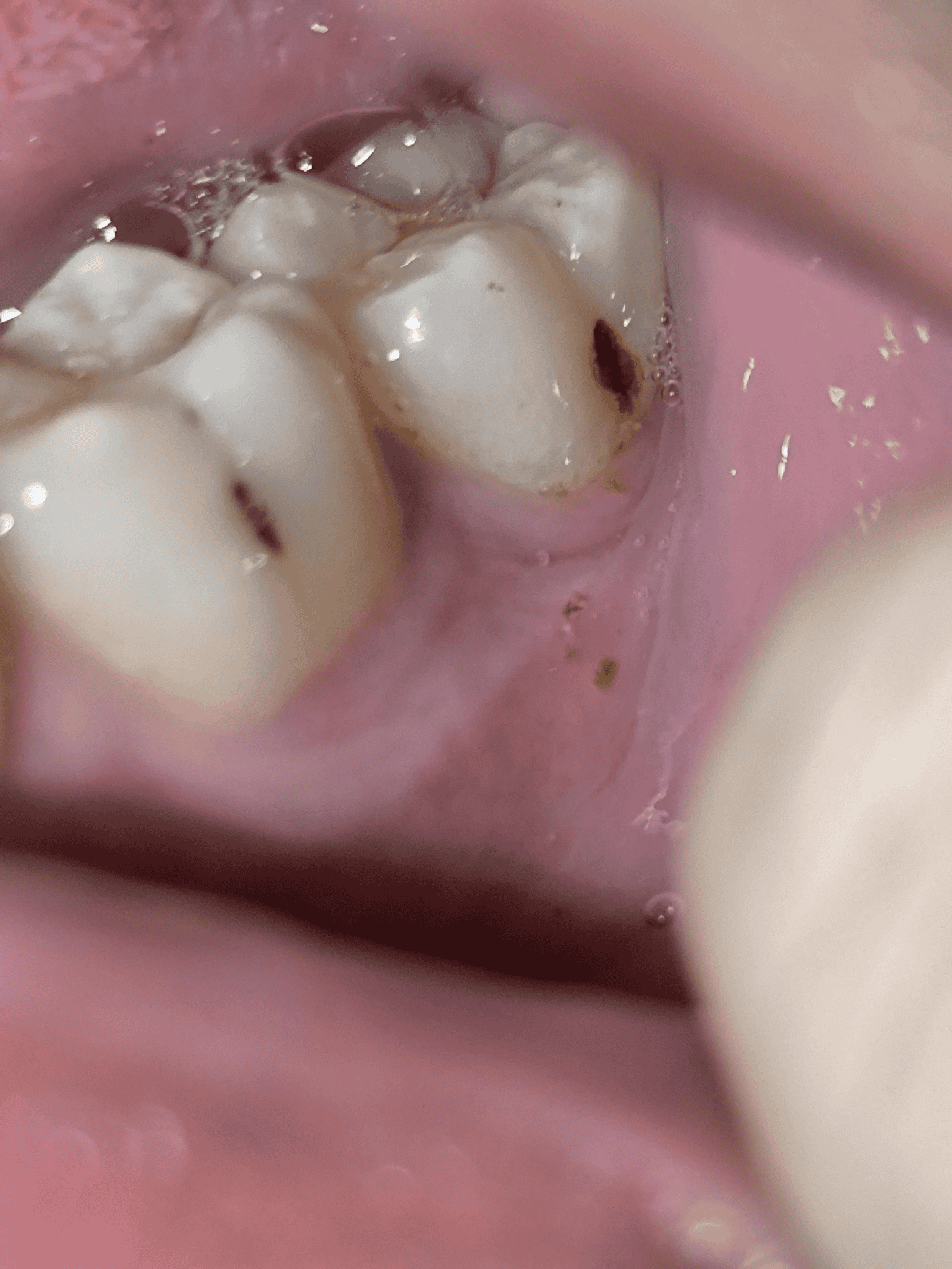 5 Types of Cavities and How to Fix Them - Anaya Dental