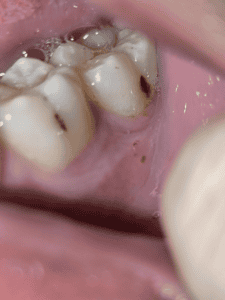 5 Types of Cavities and How to Fix Them - Anaya Dental