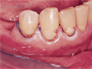5 Types of Cavities and How to Fix Them - Anaya Dental